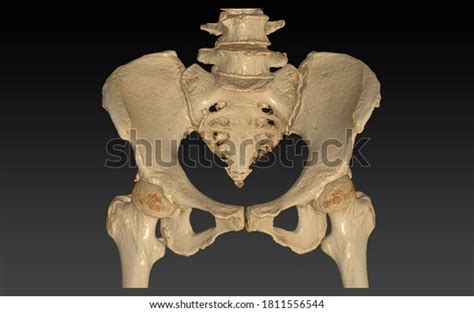 Ct Scan Pelvic Bone Both Hip Stock Illustration 1811556544 Shutterstock
