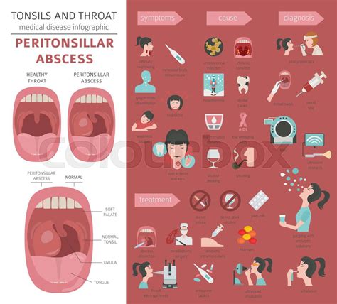 Tonsils And Throat Diseases Peritonsillar Abscess Symptoms Colourbox