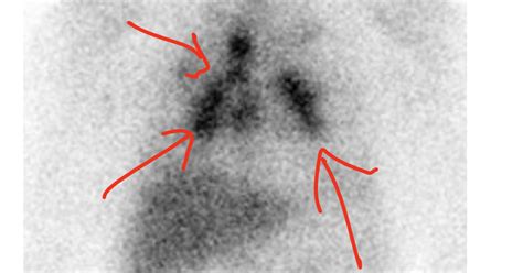 Sarcoidosis Gallium Scan Sumers Radiology Blog