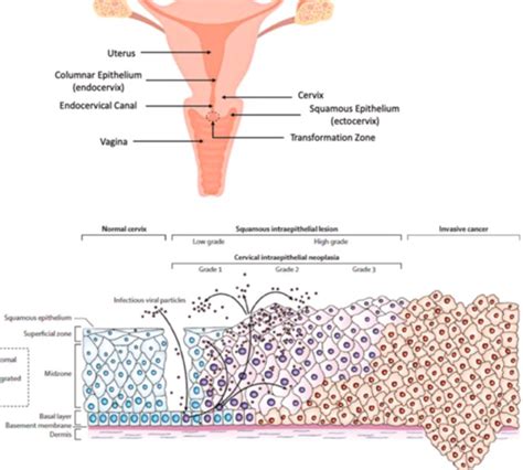 Clin Med Gynecological Malignancies Flashcards Quizlet