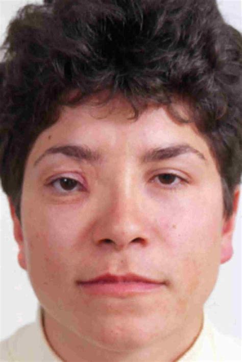 Encephalocele Types Causes Symptoms Prognosis Repair And Treatment