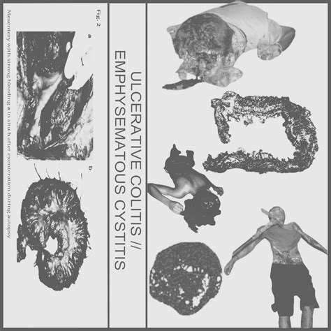 Ulcerative Colitis Emphysematous Cystitis Ulcerative Colitis Emphysematous Cystitis