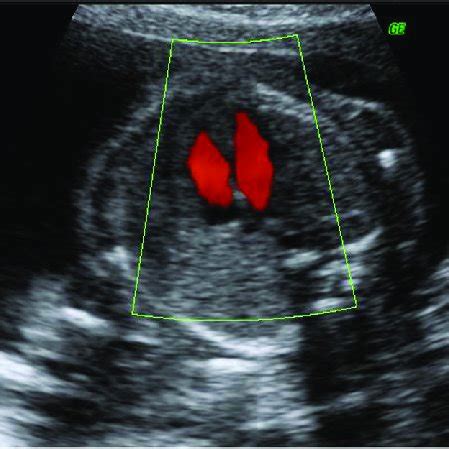 Color Doppler Flow Mapping Download Scientific Diagram