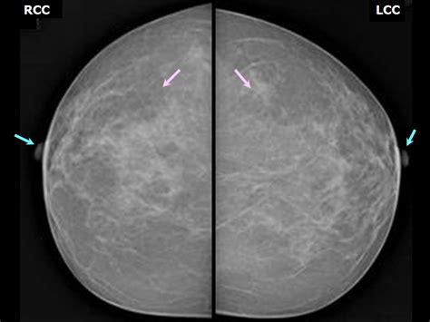 atlas of breast cancer early detection