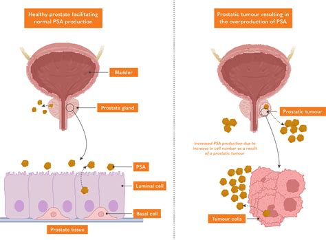 Elevated Psa All Change In The Prostate Cancer Diagnostic Pathway
