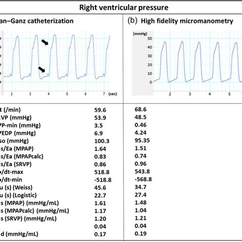 Representative Image Of Right Ventricular Pressure Recorded Via