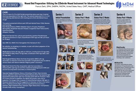 Wound Bed Preparation Utilizing The EZDebride Wound Instrument For Advanced Wound Technologies