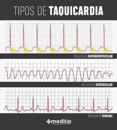 Los 12 Tipos De Taquicardia Causas Síntomas Y Tratamiento Juxk