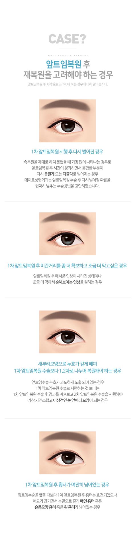 메이트성형외과 앞트임복원 뒤트임복원 눈재수술트임 복원트임재수술