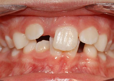 Orthodontic Treatment Before And After Crowding Orthodontix