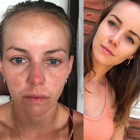 Tretinoin Before And After A Comprehensive Analysis Of Its