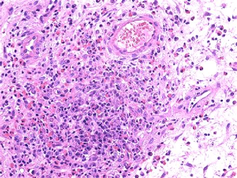 Nasal Polyp Area With Strong Lymphocytic Plasmocytic And Eosinophilic