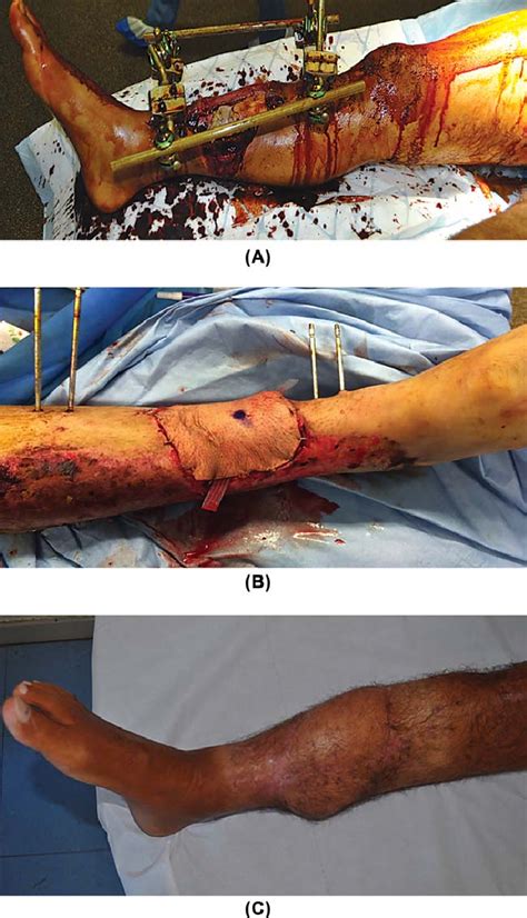 Fig Ure 3 A 45 Years Old Patient With Gustilo Type Iiib Open Download Scientific Diagram
