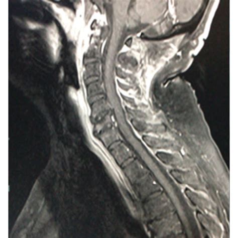 Clinical Presentation Of Patients With Autoimmune Disease Following