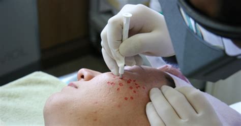 패인 여드름 흉터 들어 올리는 치료법 개발 부작용은 더 검증해봐야