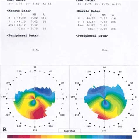 Case 5 Axial Map Demonstrating Ectasia In Both Eye Download