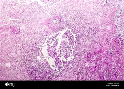 Splenic Infarction Light Micrograph Photo Under Microscope Stock