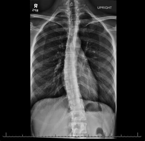 Scoliosis Diagnosis At 30yo Schroth Or Regular Pt Rscoliosis