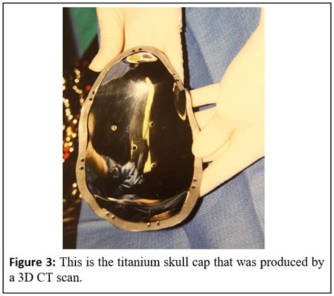 Cranioplasty Optimizing Clinical And Cosmetic Outcomes For Cranial