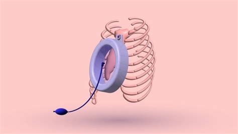 What Is Pectus Excavatum How To Improve 2024 And More