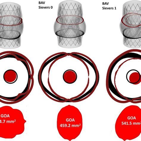 Avr Expansion In Bav Subtypes According To The Sievers Classification Download Scientific