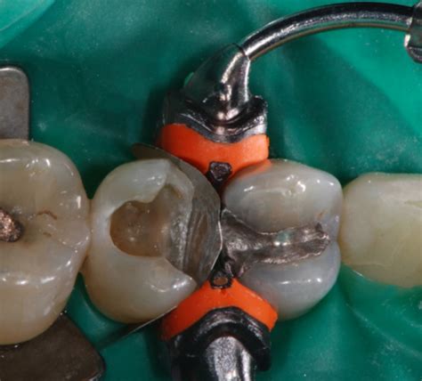 Three Surface Class Ii Composite Restorations Flashcards Quizlet