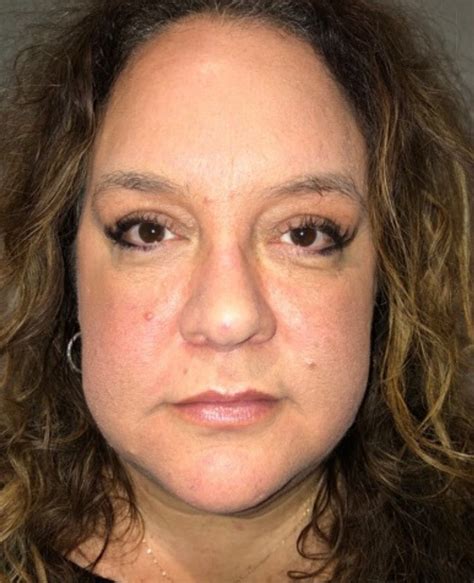 Blepharoplasty Image Surgical Arts 4506