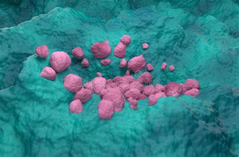 Non Small Cell Lung Cancer Nsclc In The Lung Tissue â€“ Isometric View 3d Illustration Stock