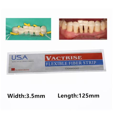 Composite Splint Dental Code At Margaret Burgin Blog