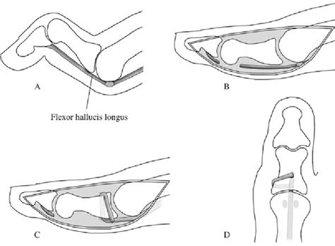 Hallux Deformity Semantic Scholar