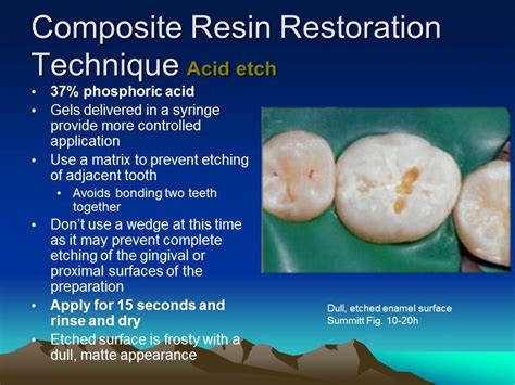 Define Composite Resin In Dentistry At Erik Wright Blog