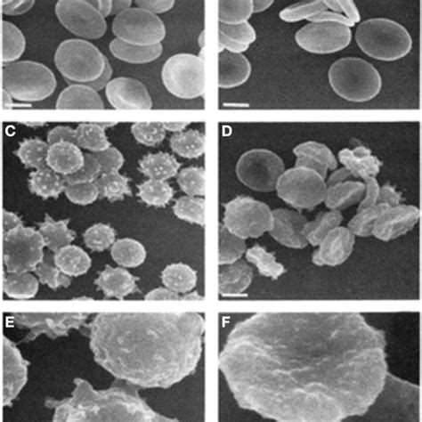 Scanning Electron Microscope Pictures Of Rbc Stored Rbc On The 5th