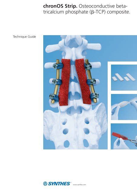 Chronos Strip Osteoconductive Beta Tricalcium Phosphate Tcp