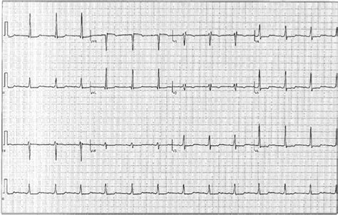 Flecainide Induced Torsades De Pointes Case Report And Review Of Literature