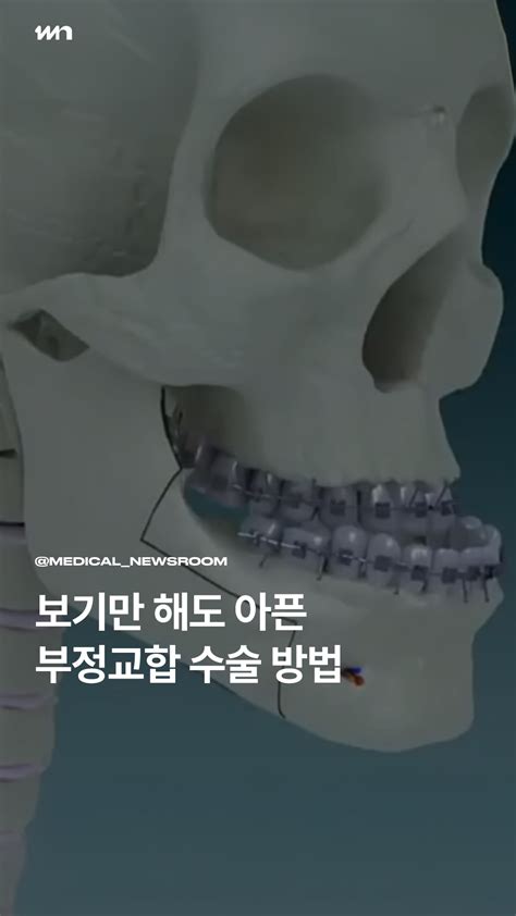 메디컬뉴스룸 ㅣ 의학계and건강 소식을 한 눈에🔍 🦷 부정교합 치료 다양한 방법을 알고 계신가요 부정교합은 치아와 턱의 불균형으로 인해 다양한 문제를 일으킬 수 있습니다