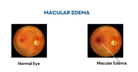 Treatment For Macular Edema Expert Insights And Solutions
