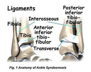 Ankle Syndesmosis Injuries Pogo Physio Gold Coast