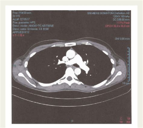 computed tomography evidence of bilateral subsegmental pulmonary