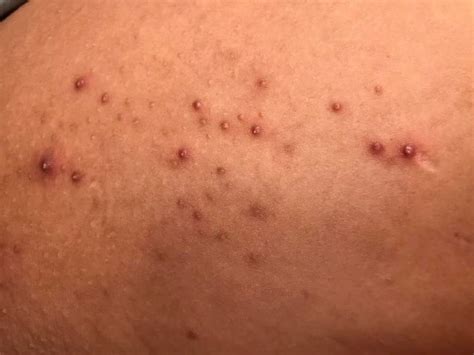 Follicular Hyperkeratosis