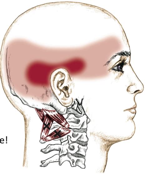 Functional Integrative Rehabilitation Education The Rectus Capitis