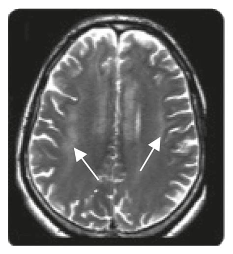 MRI Image Of Acute Brain Edema Download Scientific Diagram