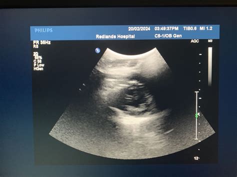Philips C5 1 Convex Array Ultrasound Transducer Probe Auschoice
