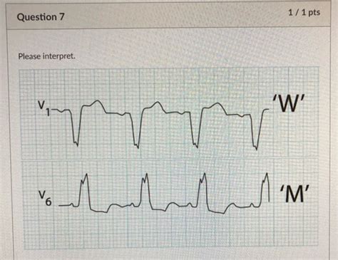 Ekg Bundle Branch Block Flashcards Quizlet