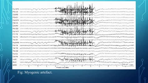 Eeg Lecture 3 Artifacts And Benign Eeg Variants Pptx