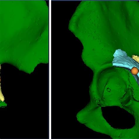 Simulation Of Fracture Reduction An Anatomical Reduction In All Three