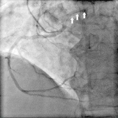 Preoperative Coronary Angiography During Injection Of The Contrast Dye Download Scientific
