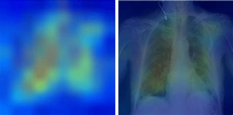 Explainability Heatmaps Using Grad Cam Algorithm Shows That The Model