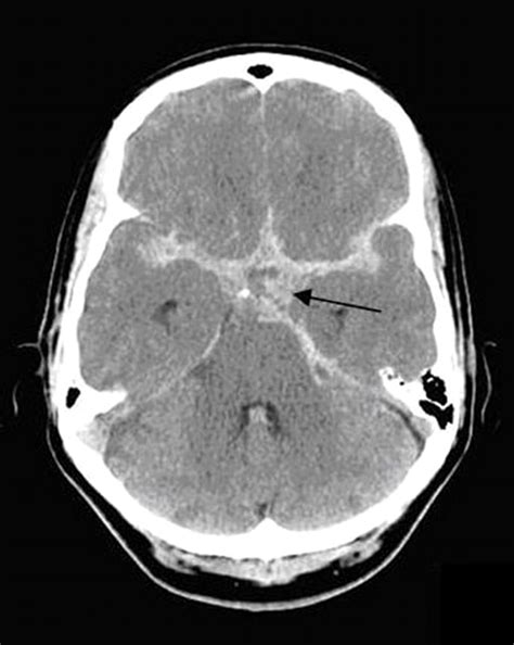 Investigating Suspected Subarachnoid Haemorrhage In Adults The Bmj