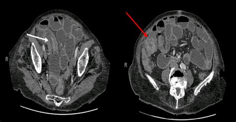 [pdf] Ileo Colic Intussusception Caused By An Inflammatory Fibroid Polyp Of The Ileum A Rare