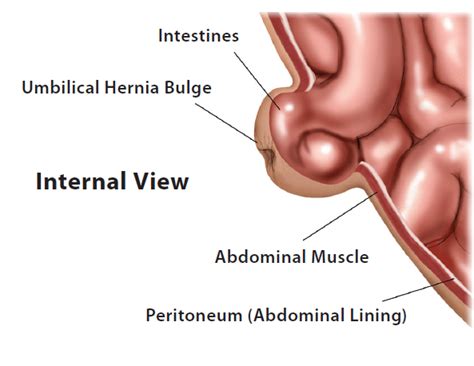 Adult Umbilical Hernia Acs